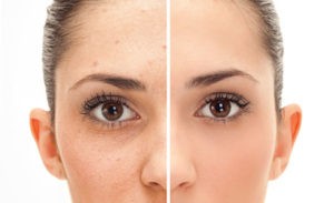 VERRUES DU VISAGE : 13 Remèdes Maison Efficaces (Faciles)