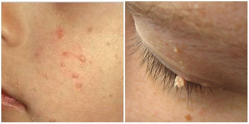 VERRUES DU VISAGE : 13 Remèdes Maison Efficaces (Faciles)