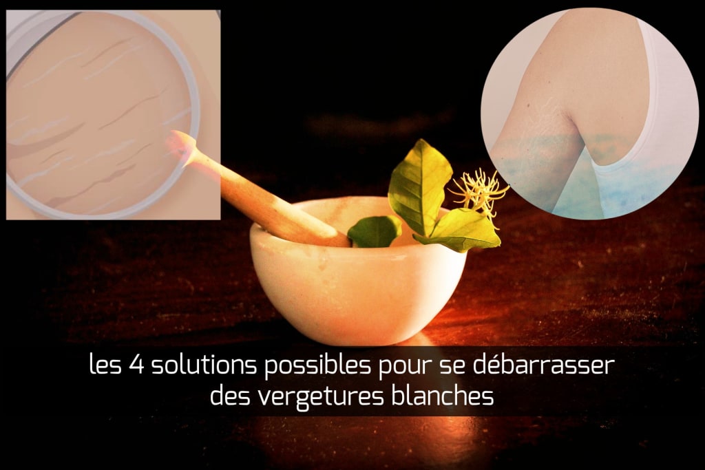 Enlever Les Vergetures Blanches : 9 Traitements (Naturels)