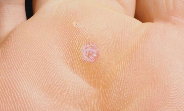 Comment Enlever une Verrue Plantaire Efficacement et Naturellement