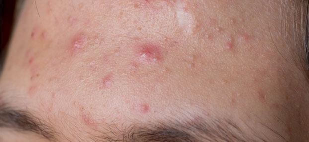 Boutons sur le Front (Petits et Gros) : 10 Remèdes Faciles et Efficaces