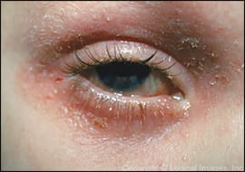 Soigner l'Eczéma des Paupières : 3 Remèdes de Grand-Mère Efficace