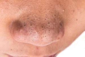 Comment Enlever les Points Noirs sur le Nez Facilement