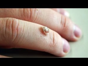 Enlever les Verrues sur les Mains ou les doigts : 6 Remèdes Efficaces