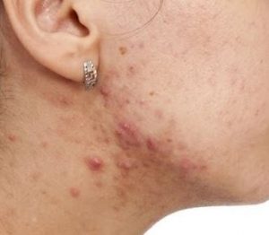 Comment se débarrasser des boutons dans le cou (Causes et Remèdes)
